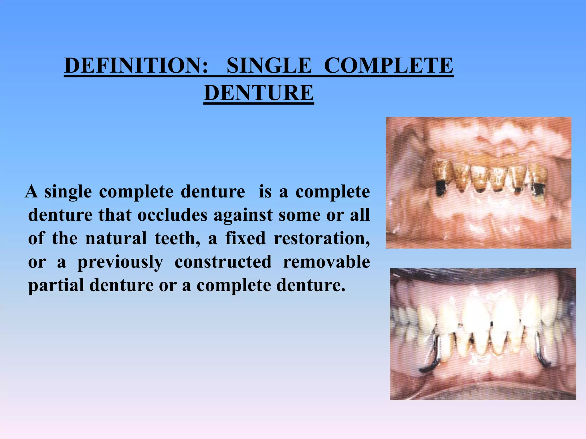 Single complete denture final ppt - copy | PPTX