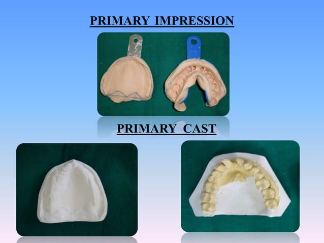 Single complete denture final ppt - copy | PPTX | Dental Health ...