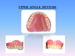 Single complete denture final ppt - copy | PPTX