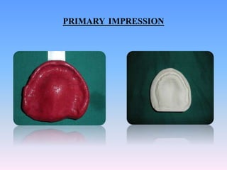 Single complete denture final ppt - copy | PPTX