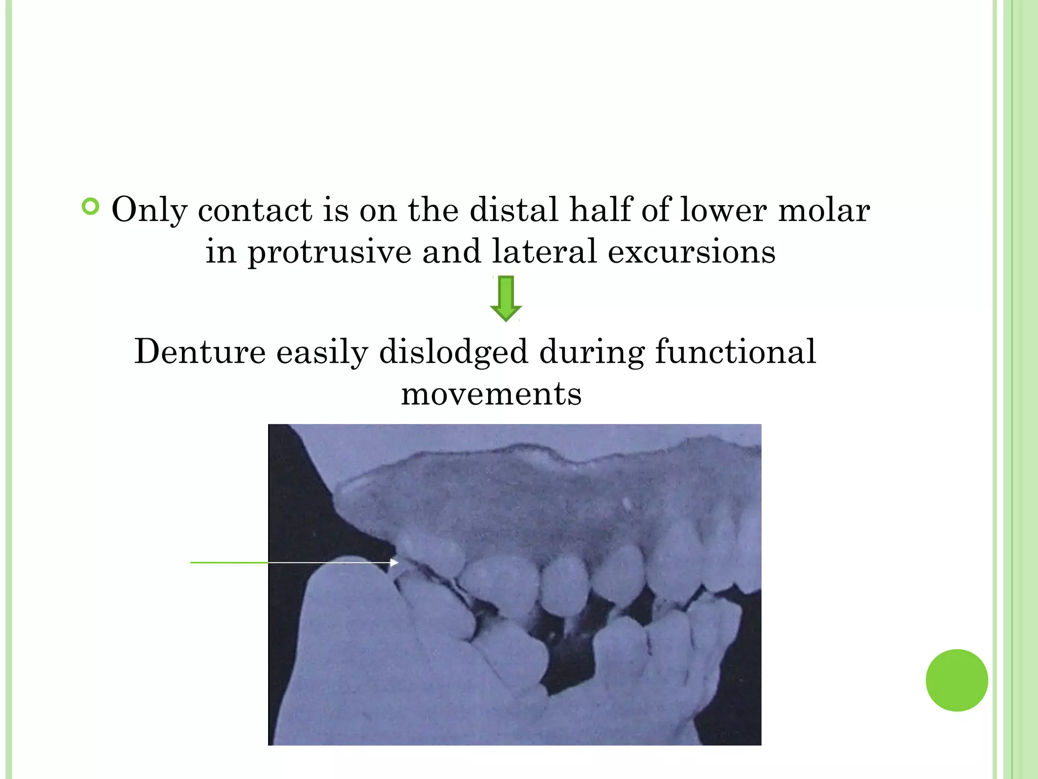 Single Complete Denture | PPT