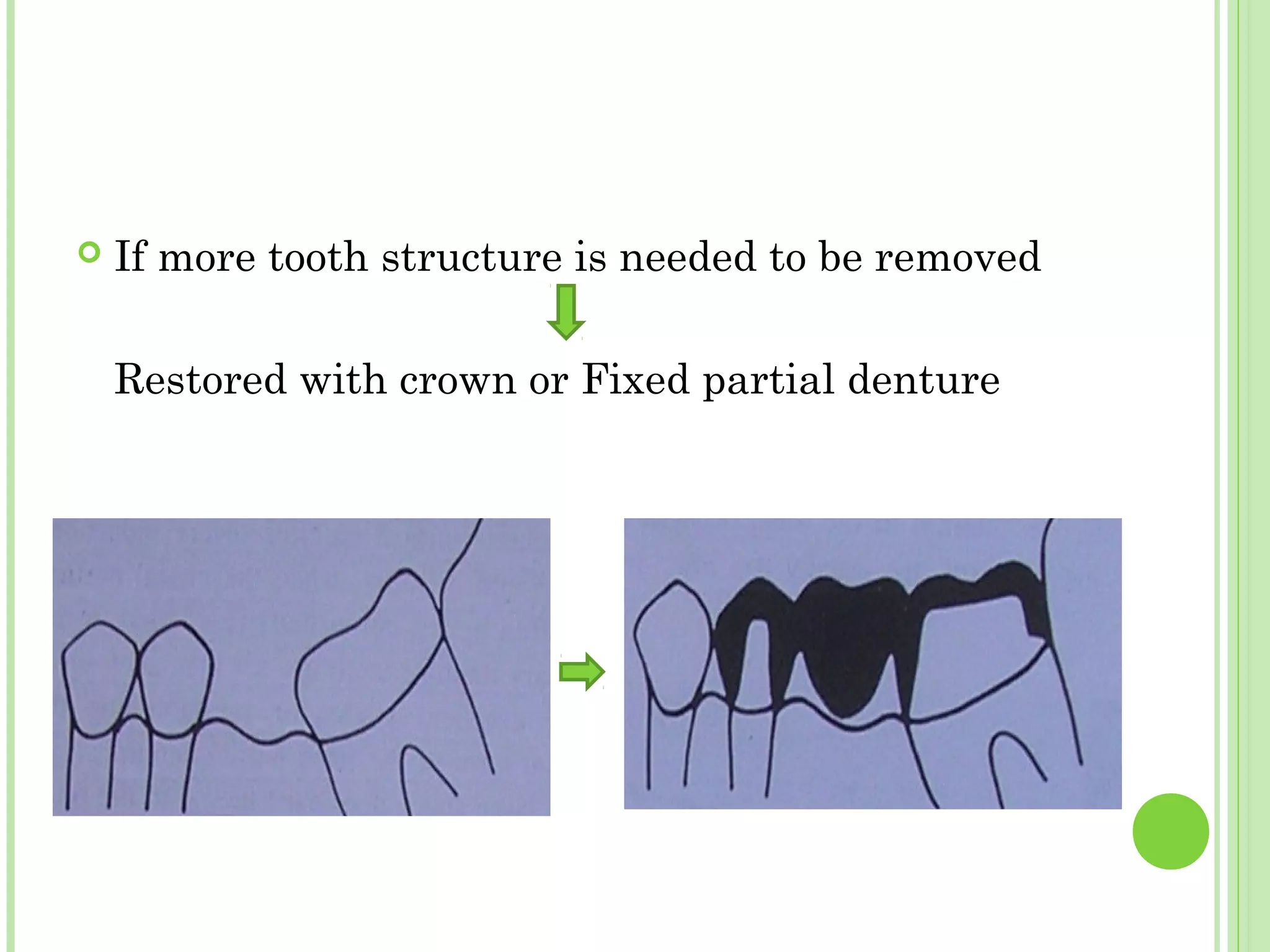 Single Complete Denture | PPT