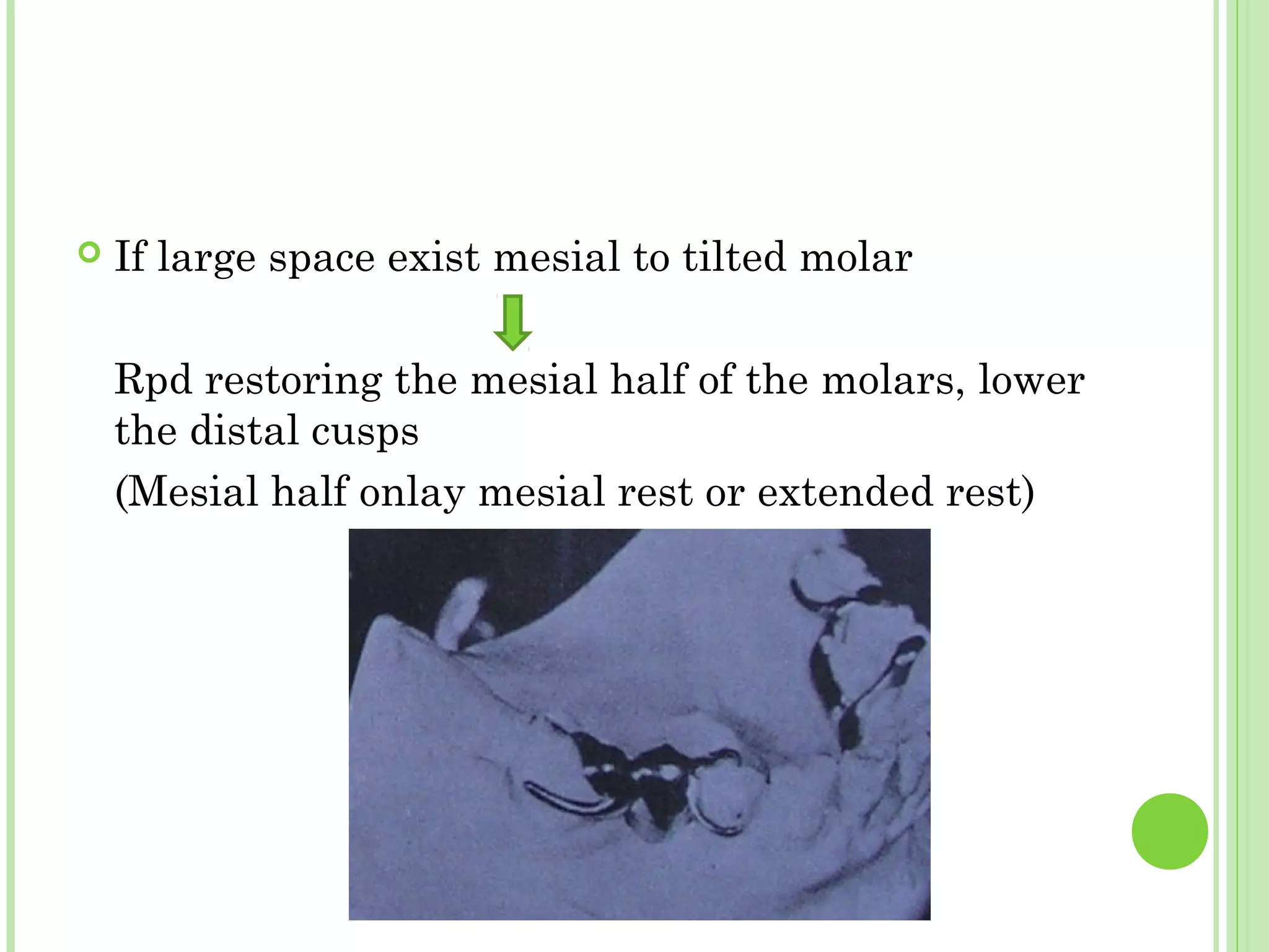 Single Complete Denture | PPT