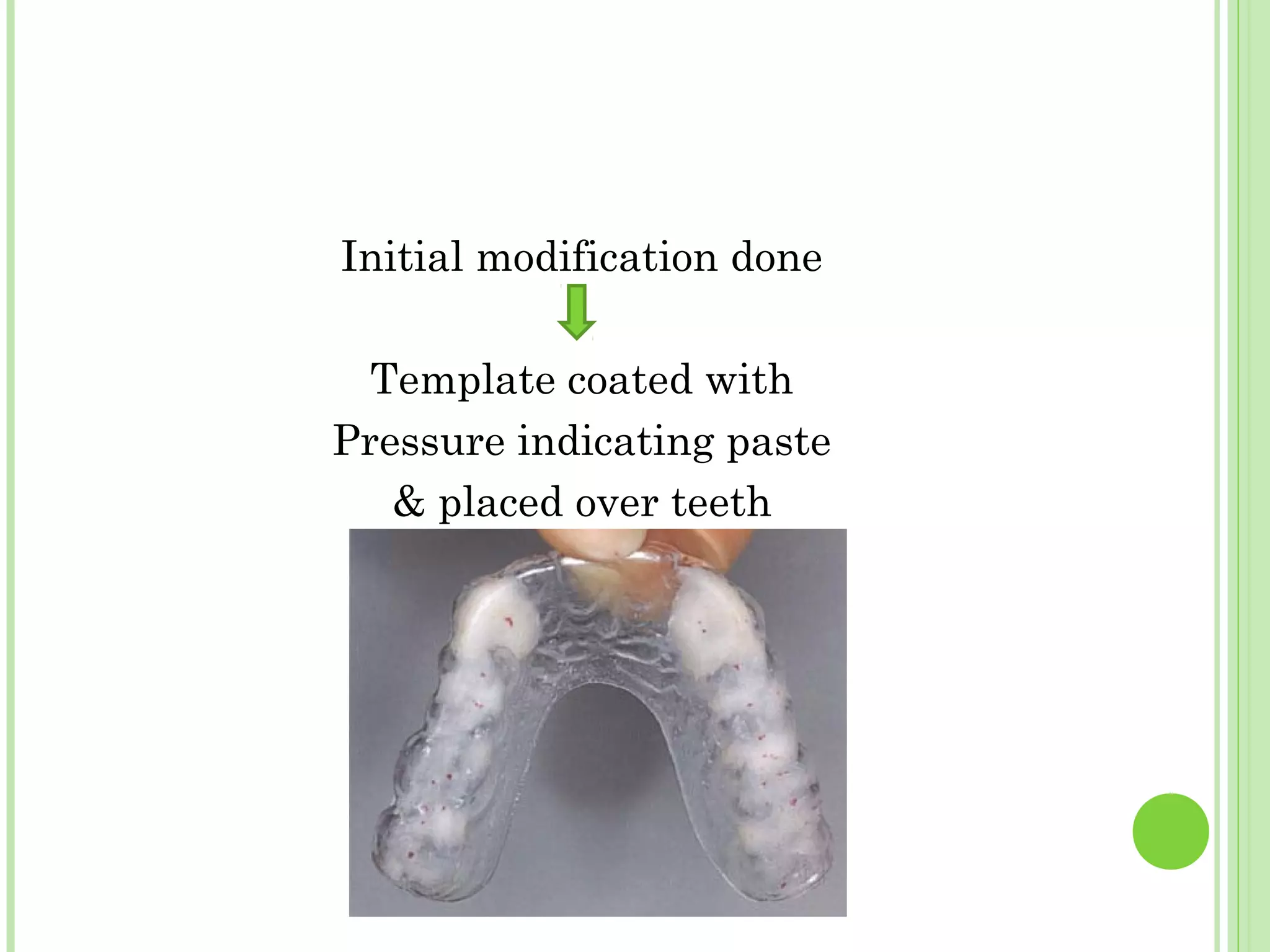 Single Complete Denture | PPT