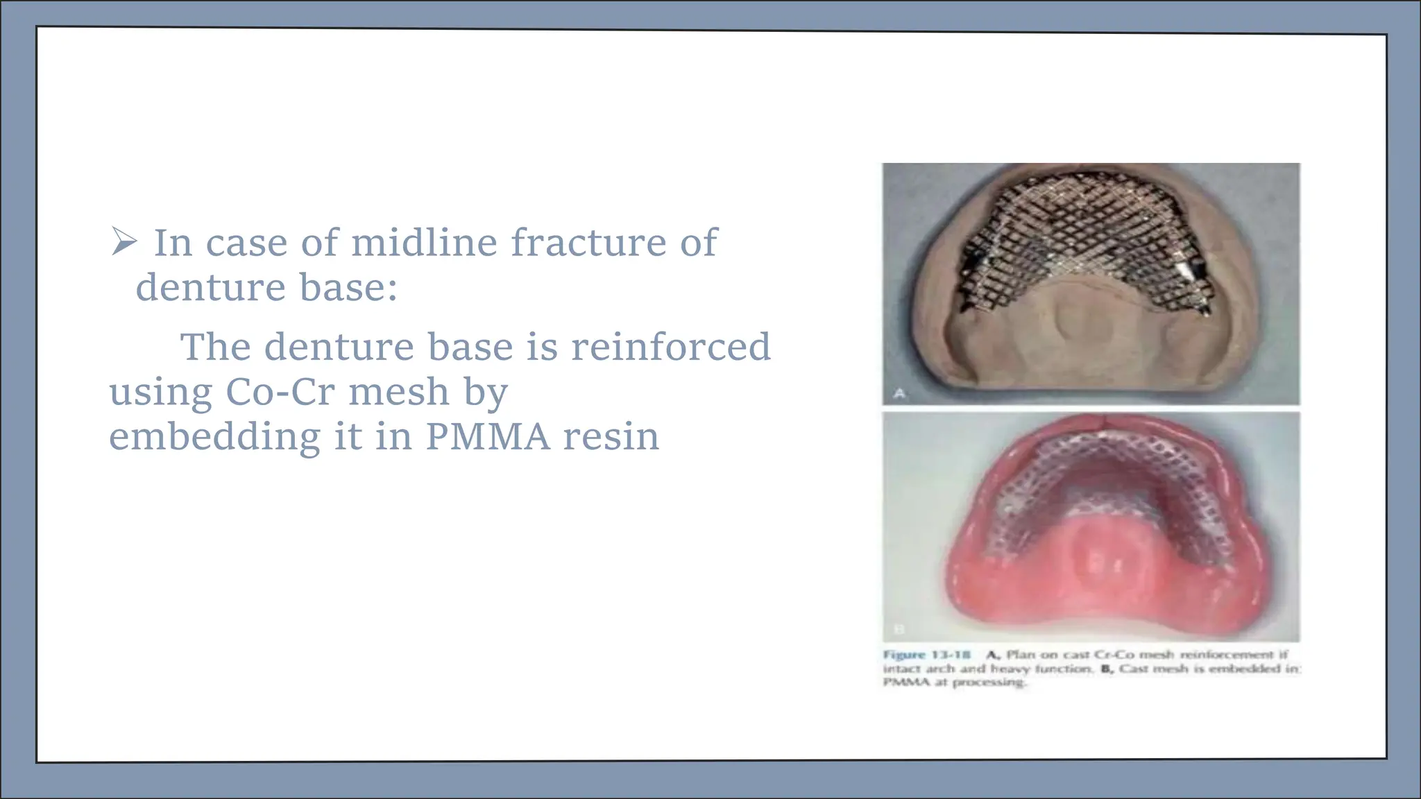 Single Complete Dentures.pptx