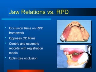 Single Complete Dentures (1).ppt dental | PPT