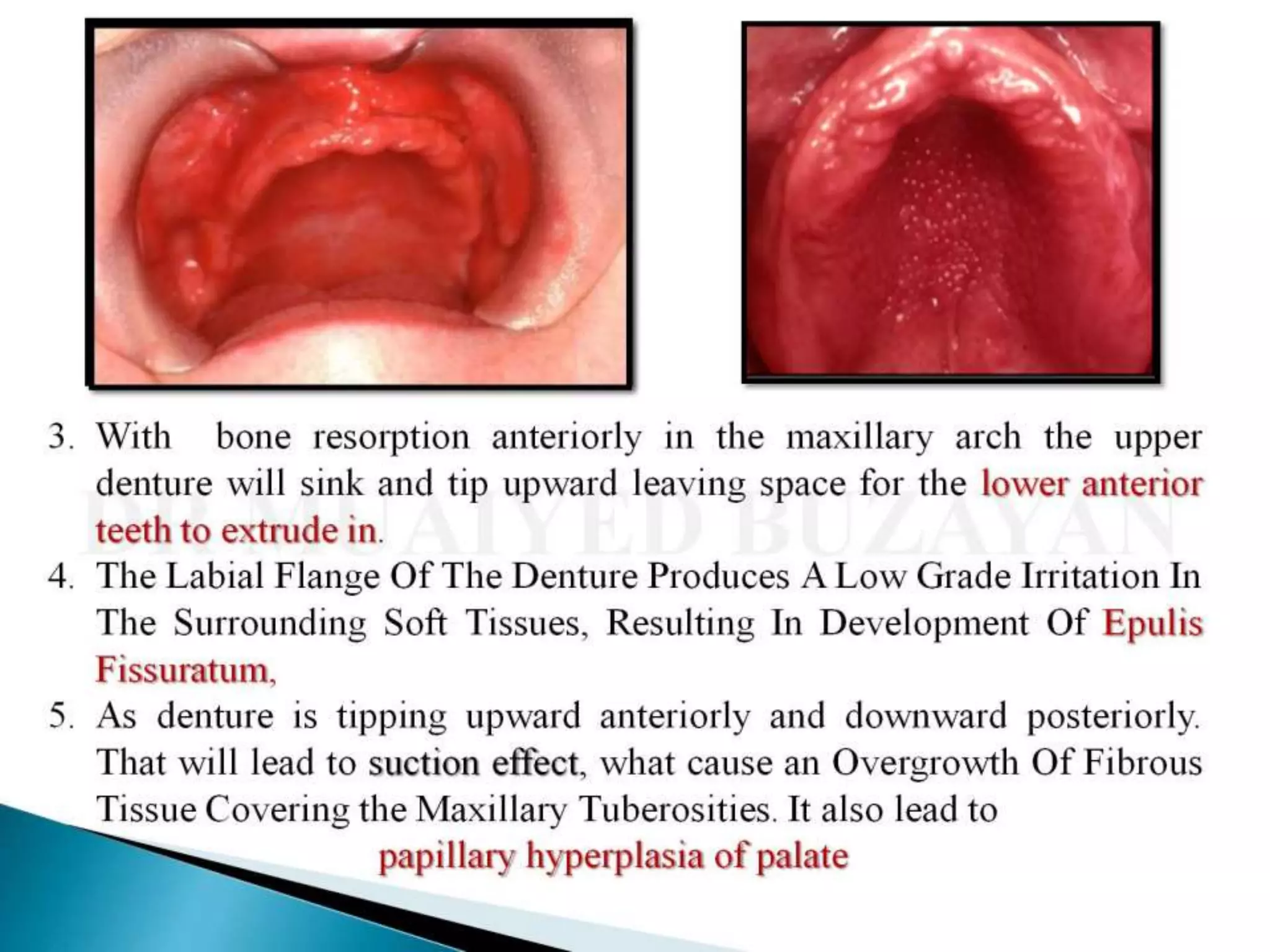 Single denture | PPTX