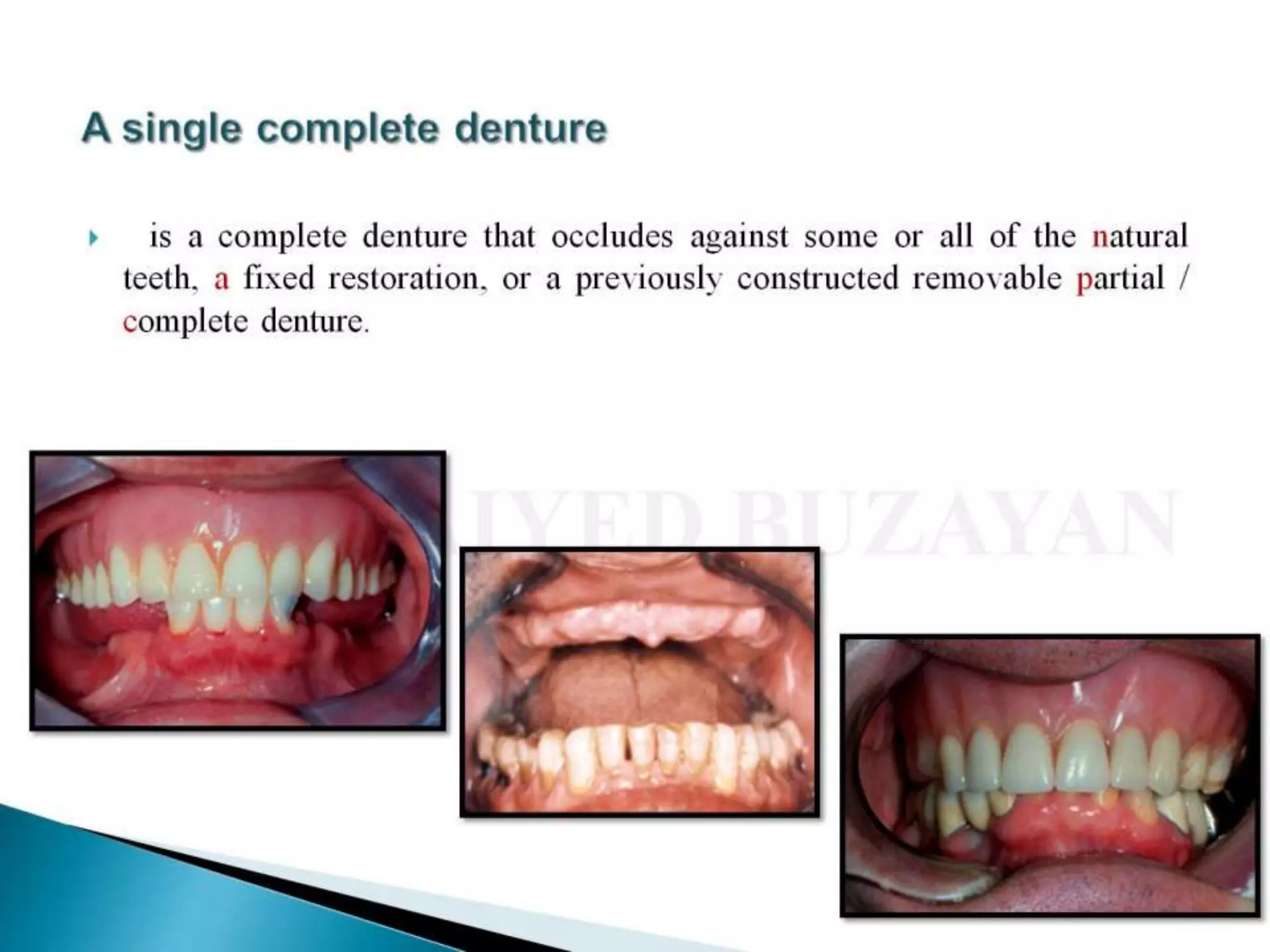 Single denture | PPTX