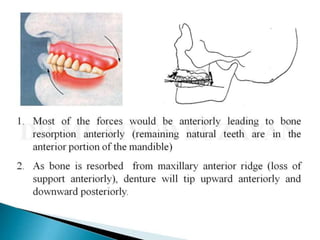 Single denture | PPTX