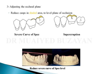 Single denture | PPTX