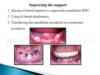 Single denture | PPTX
