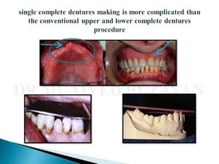 Single denture | PPTX