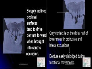 Single denture | PPT
