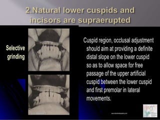 Single denture | PPT