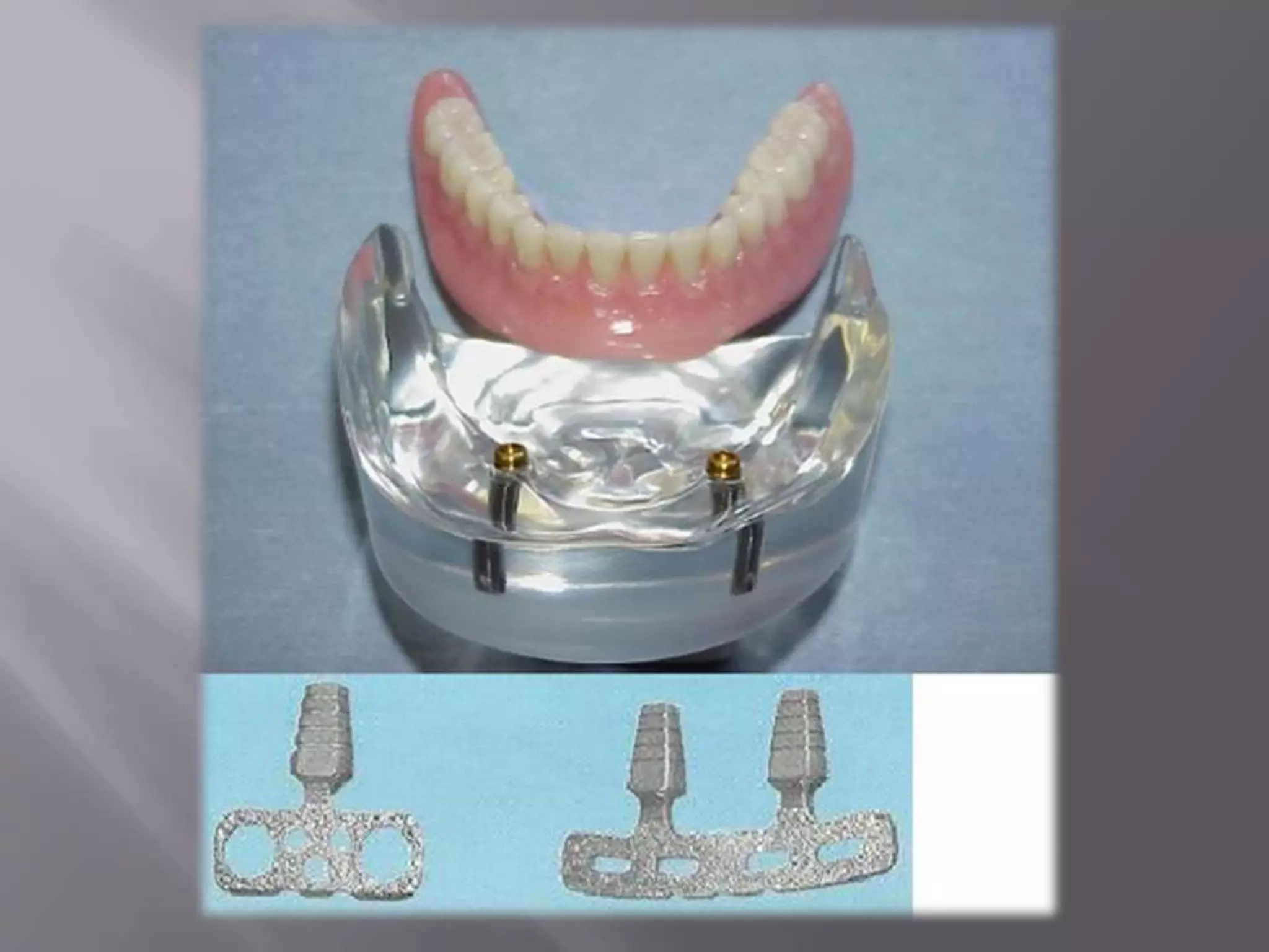 Single denture construction technique | PPTX