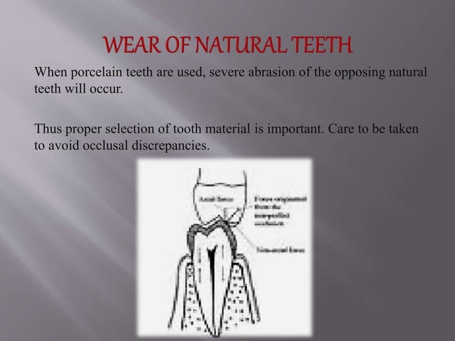 Single denture construction technique | PPTX