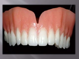Single denture construction technique | PPTX