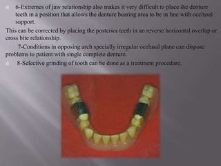 Single denture construction technique | PPTX