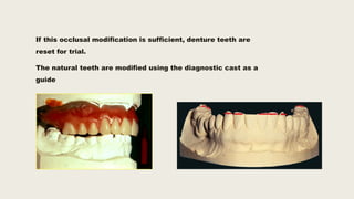 single denture removable prosthodontics.pptx