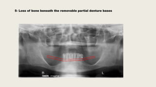 single denture removable prosthodontics.pptx