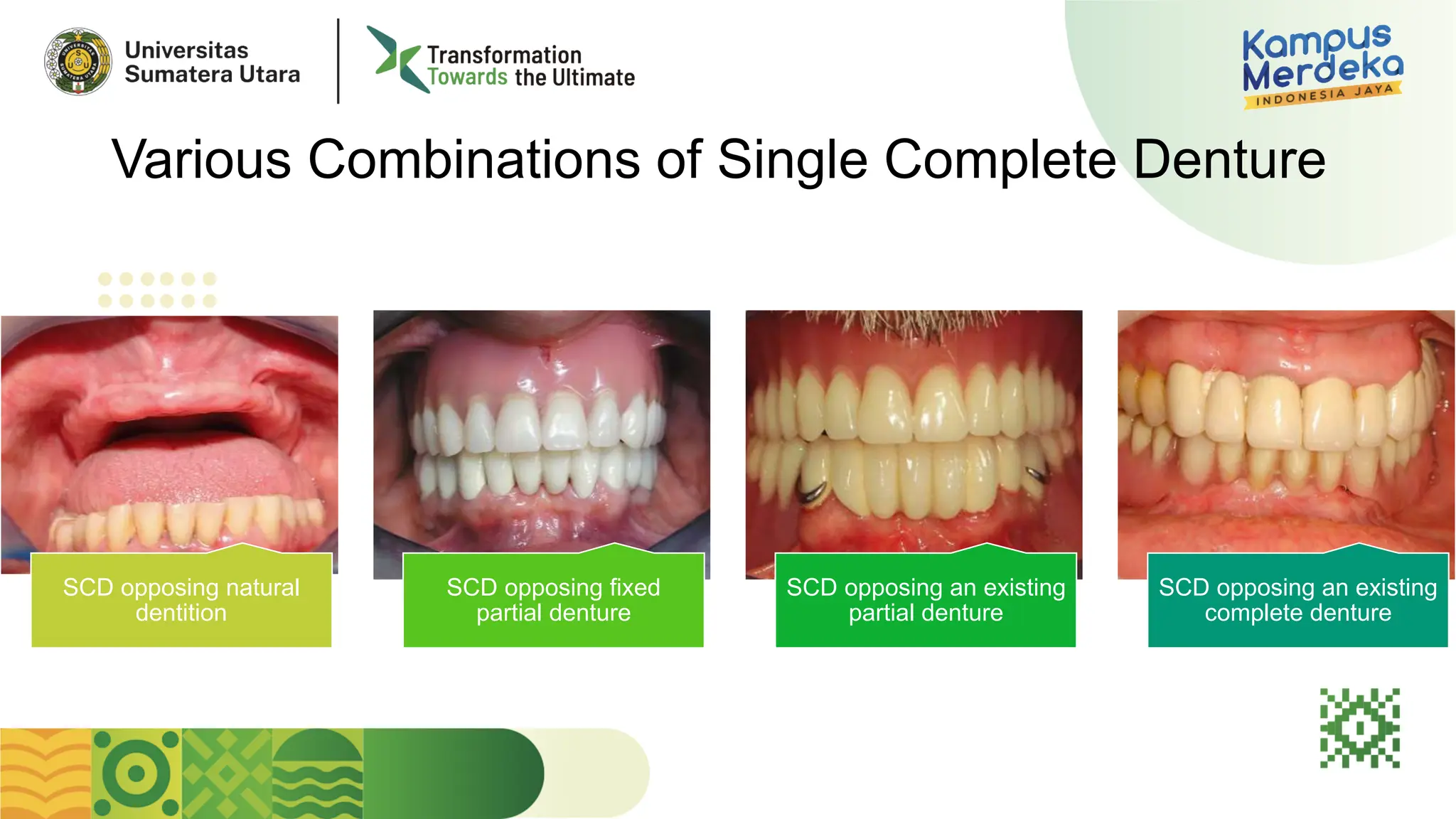 Key point of Single complete denture ppt | PPTX