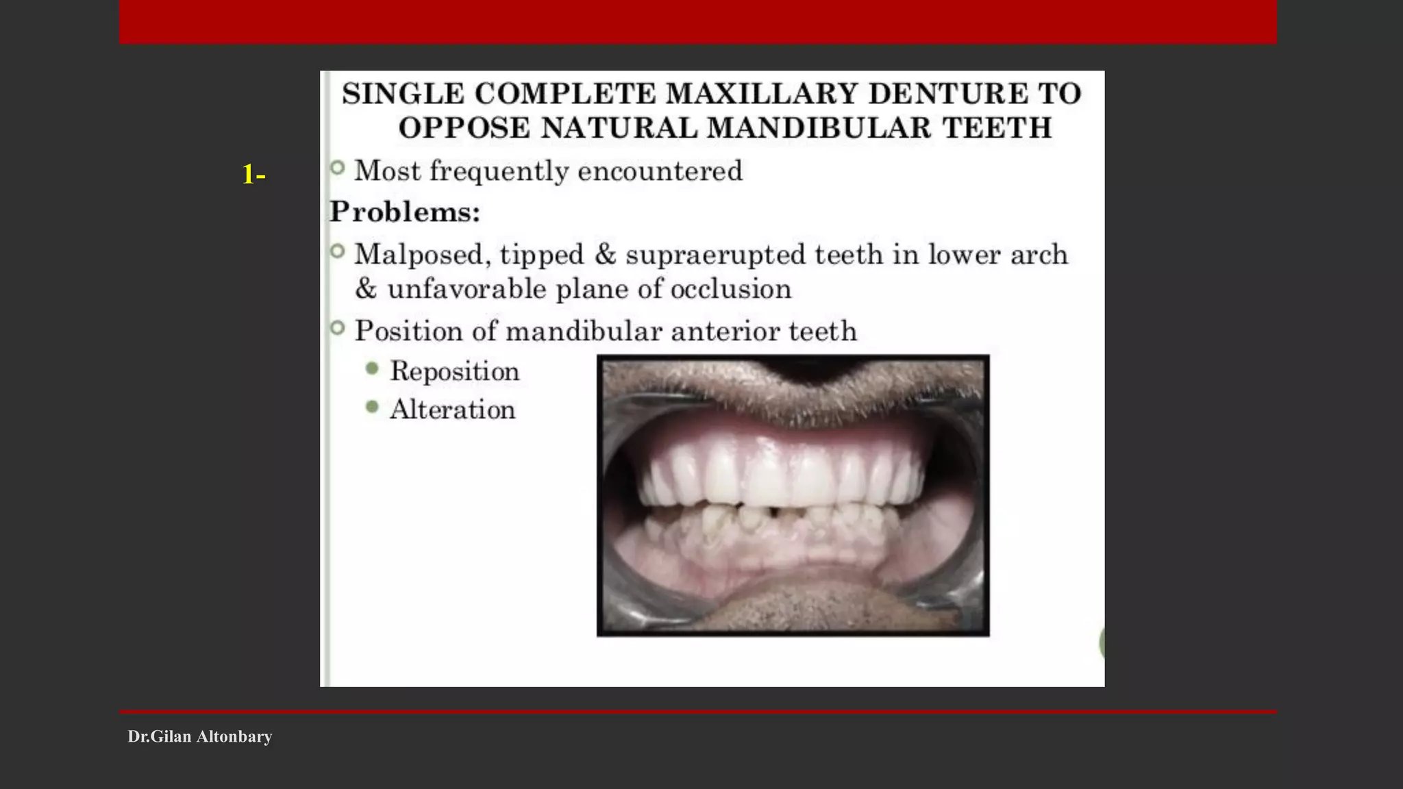 single denture kelly syndrome.pdf