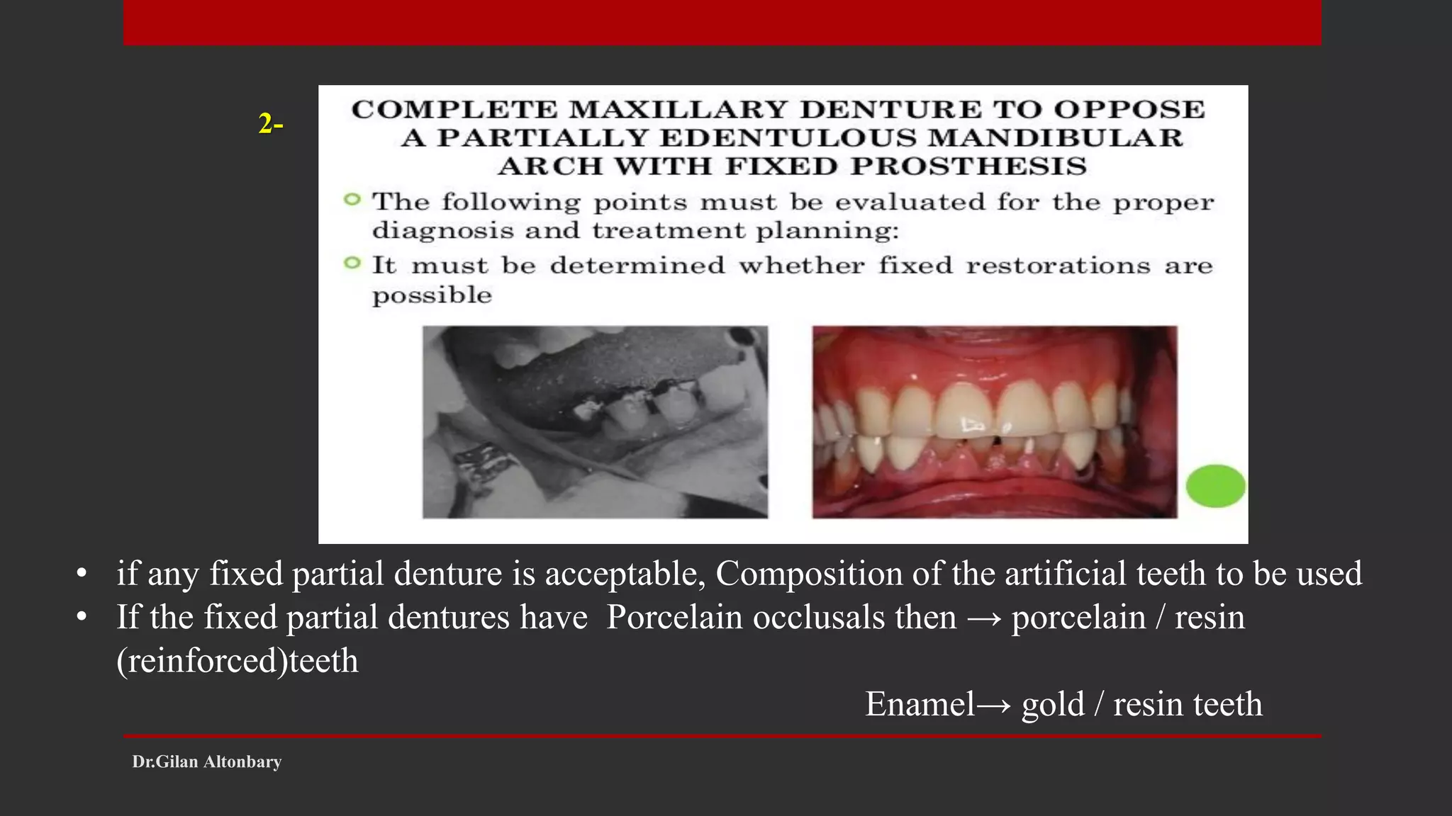 single denture kelly syndrome.pdf