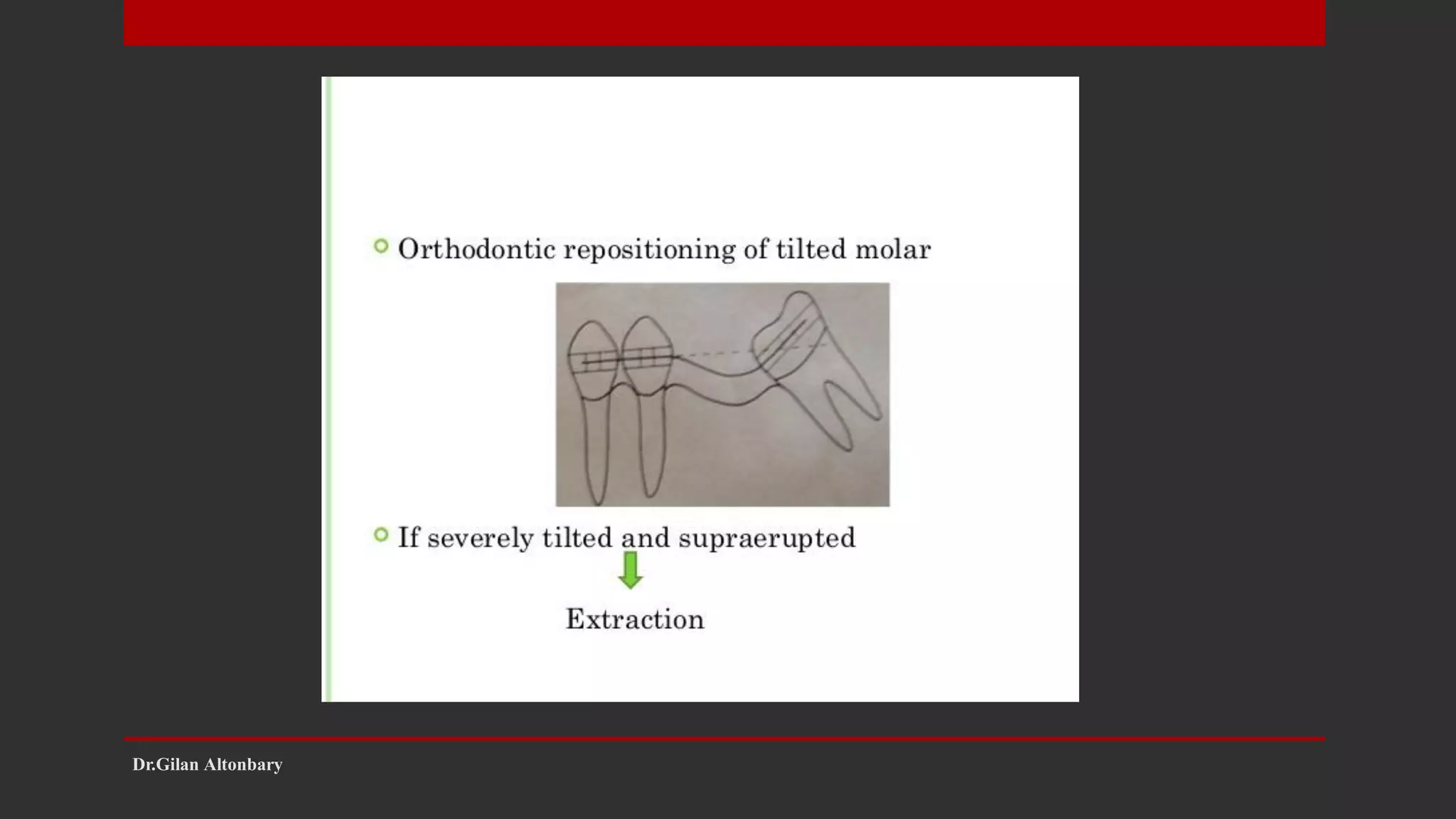 single denture kelly syndrome.pdf