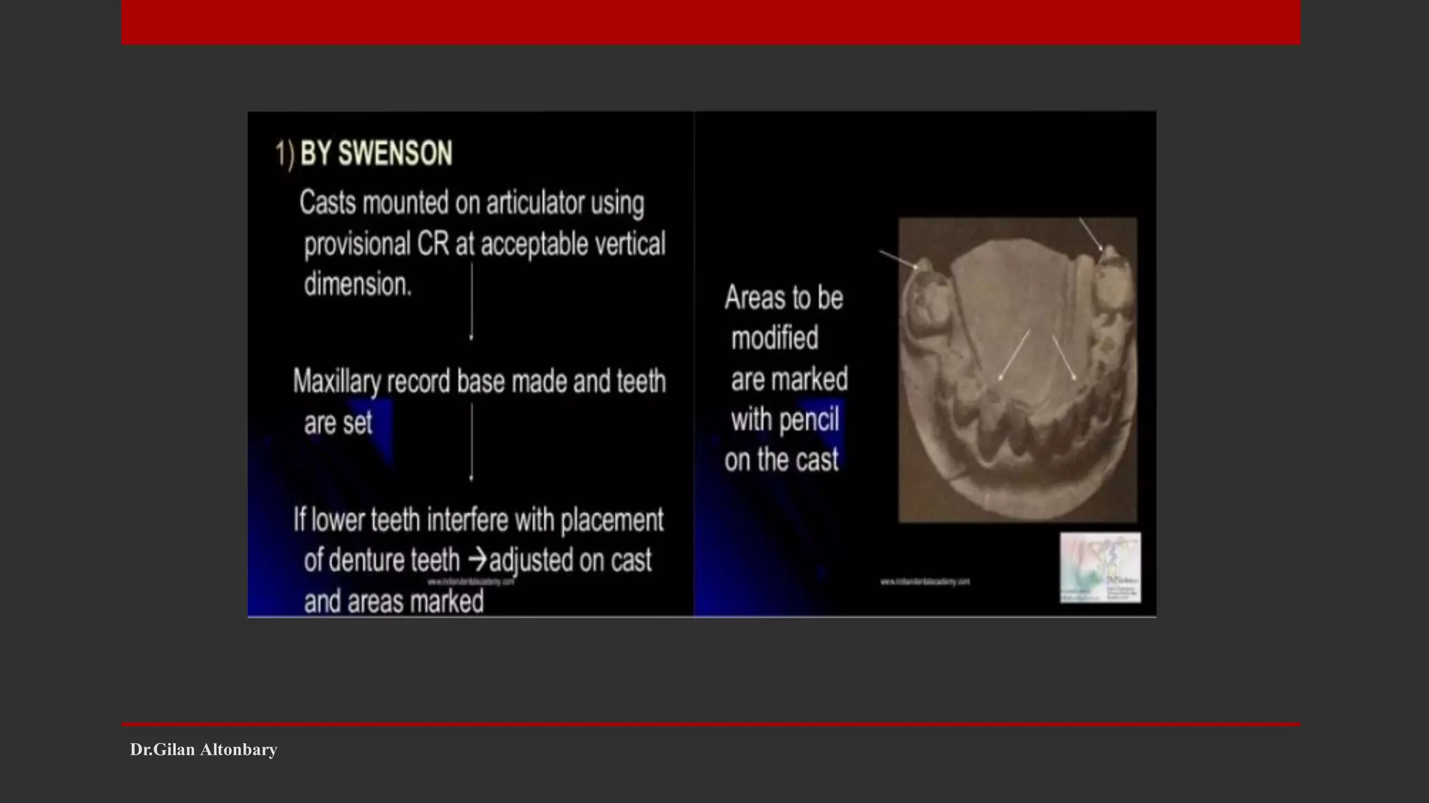 single denture kelly syndrome.pdf