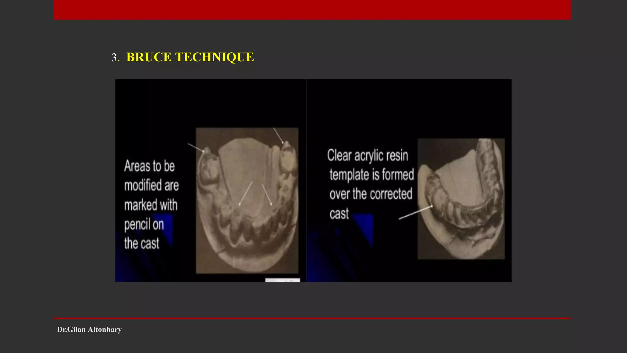 single denture kelly syndrome.pdf