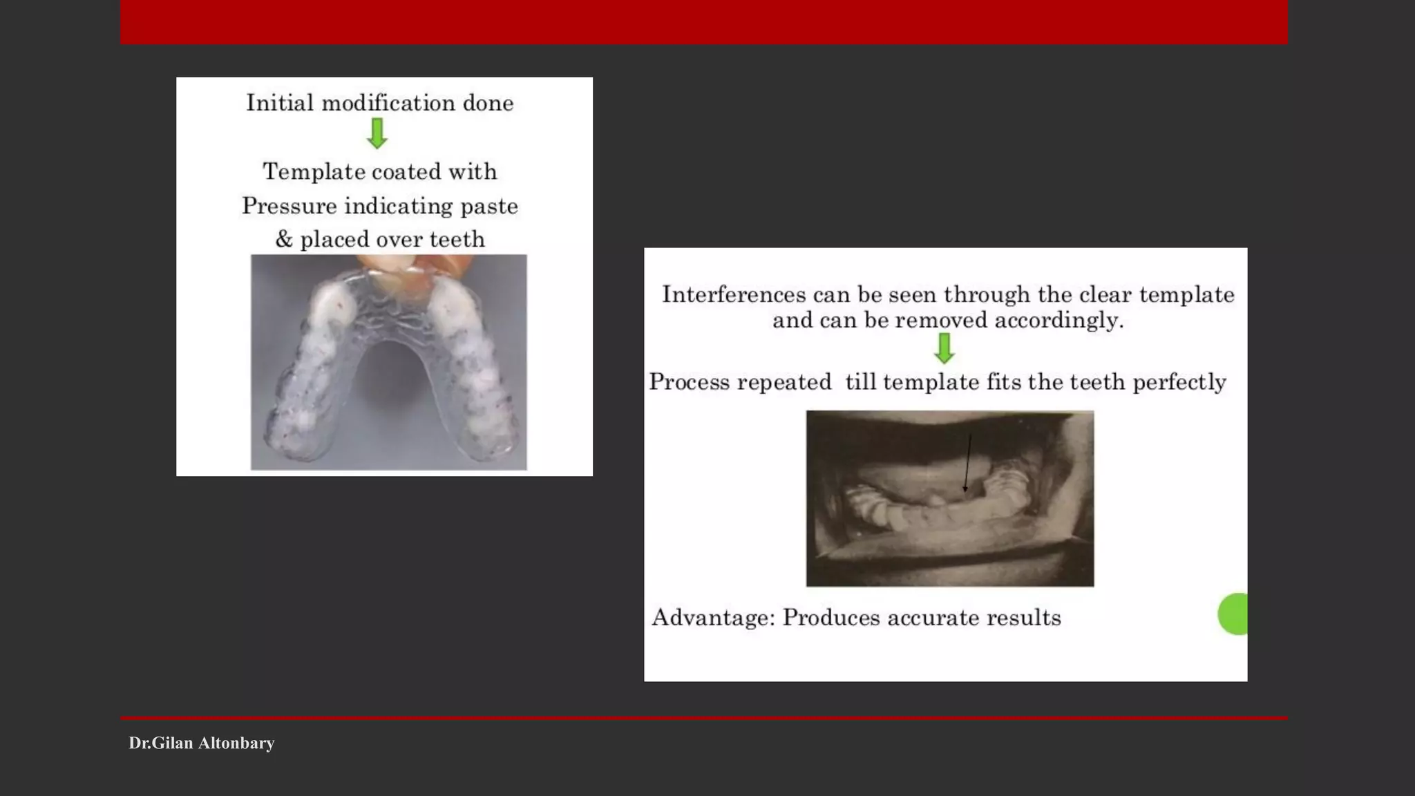 single denture kelly syndrome.pdf