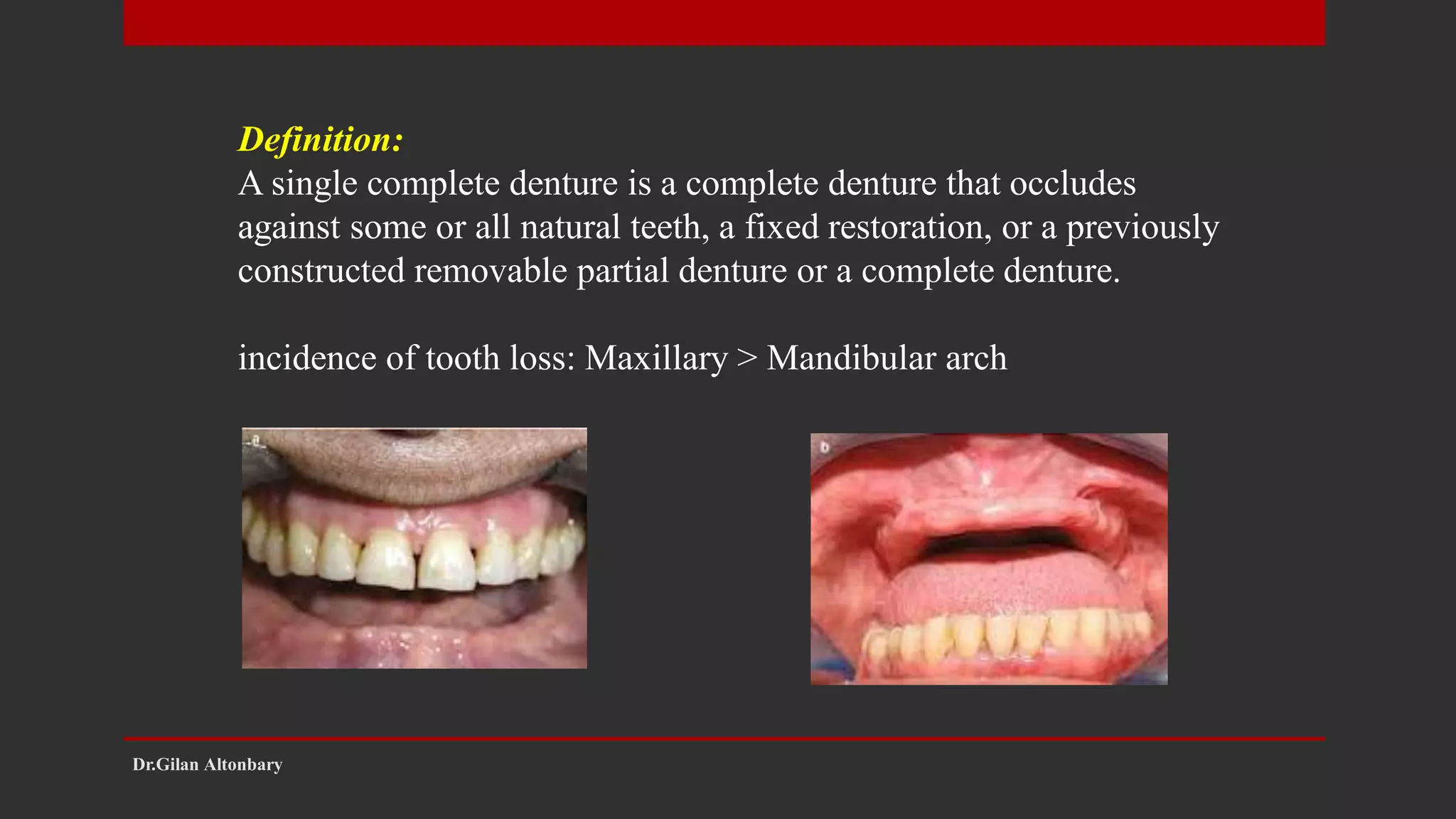 single denture kelly syndrome.pdf