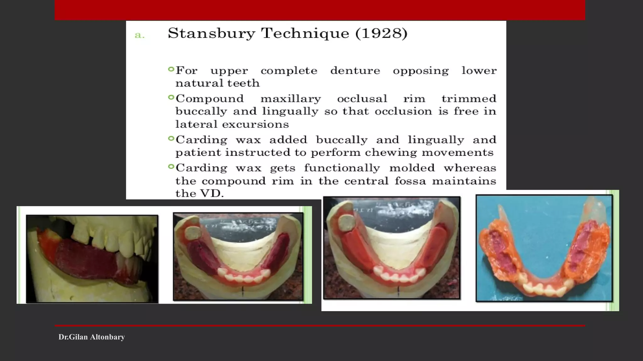 single denture kelly syndrome.pdf