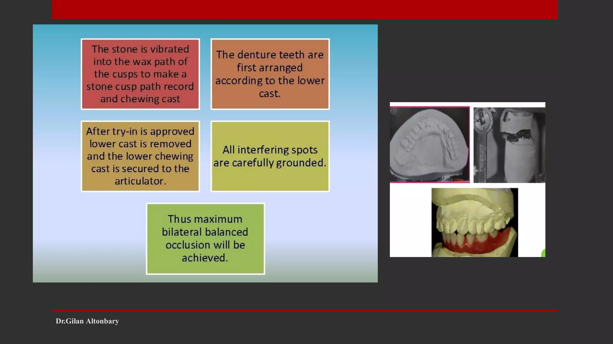 single denture kelly syndrome.pdf