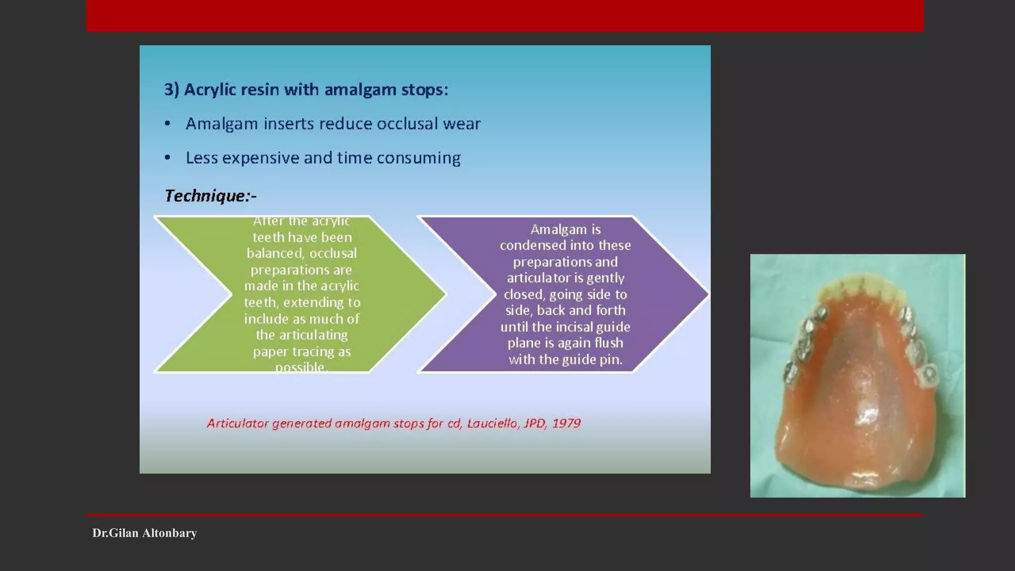 single denture kelly syndrome.pdf