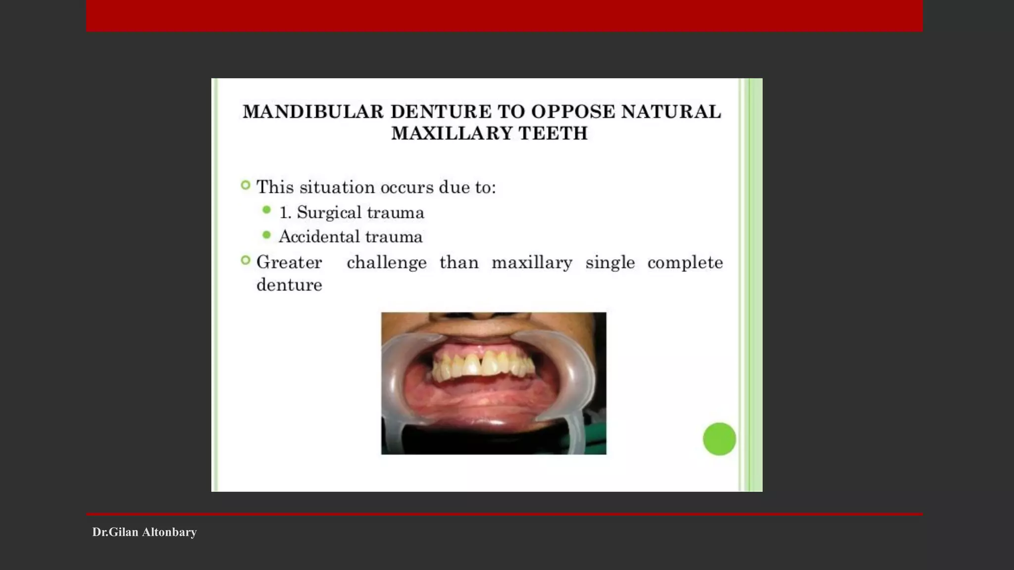 single denture kelly syndrome.pdf