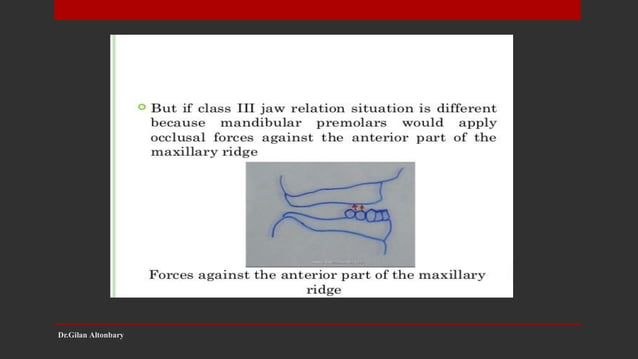 single denture kelly syndrome.pdf