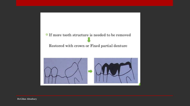 single denture kelly syndrome.pdf