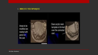 single denture kelly syndrome.pdf