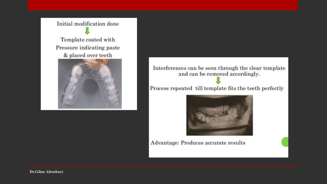 single denture kelly syndrome.pdf