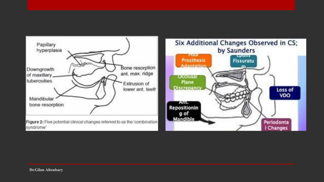 single denture kelly syndrome.pdf
