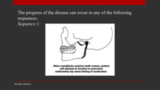 single denture kelly syndrome.pdf