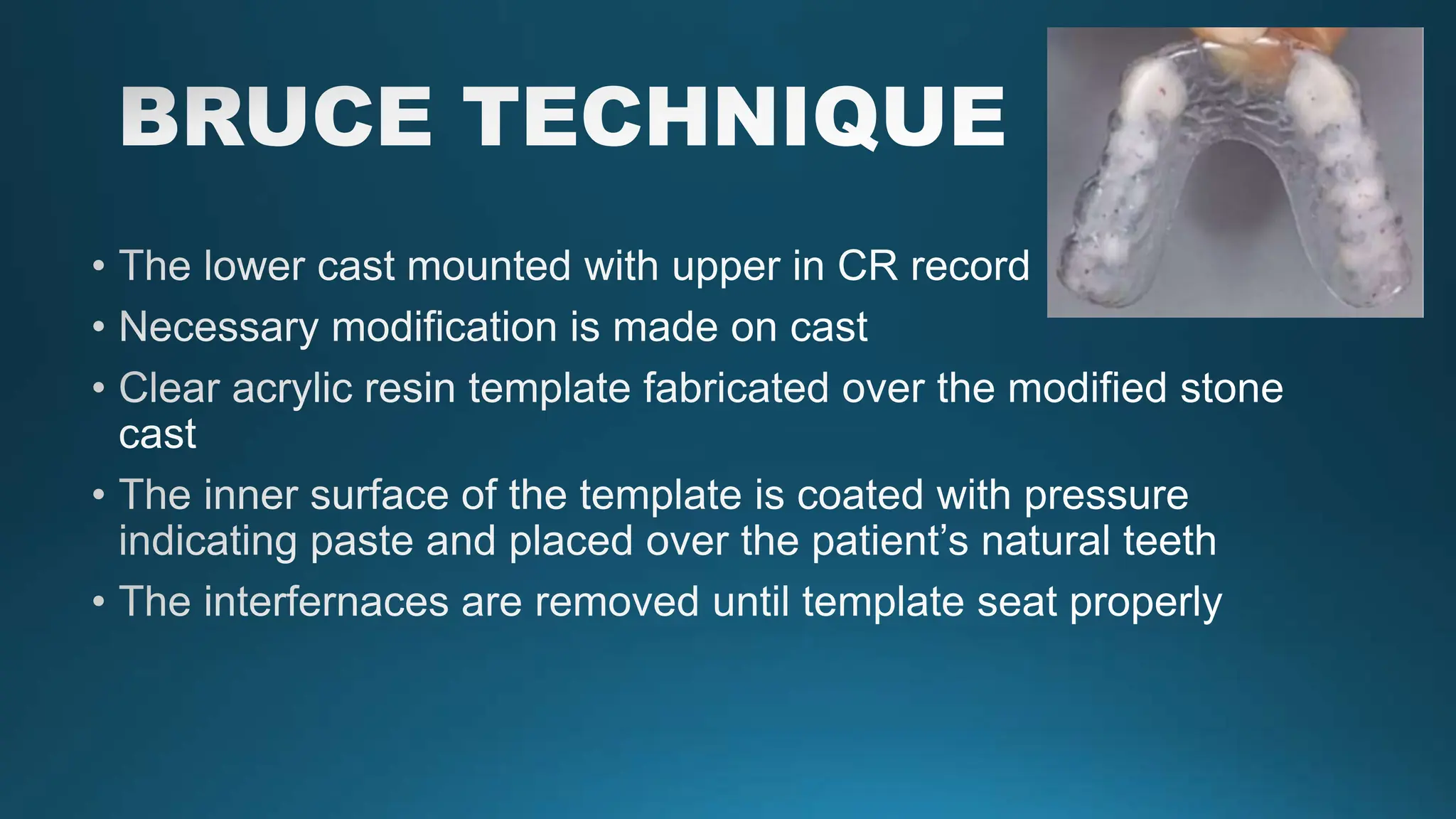 SINGLE MAXILLARY DENTURE AND ITS MANAGEMENT | PPTX