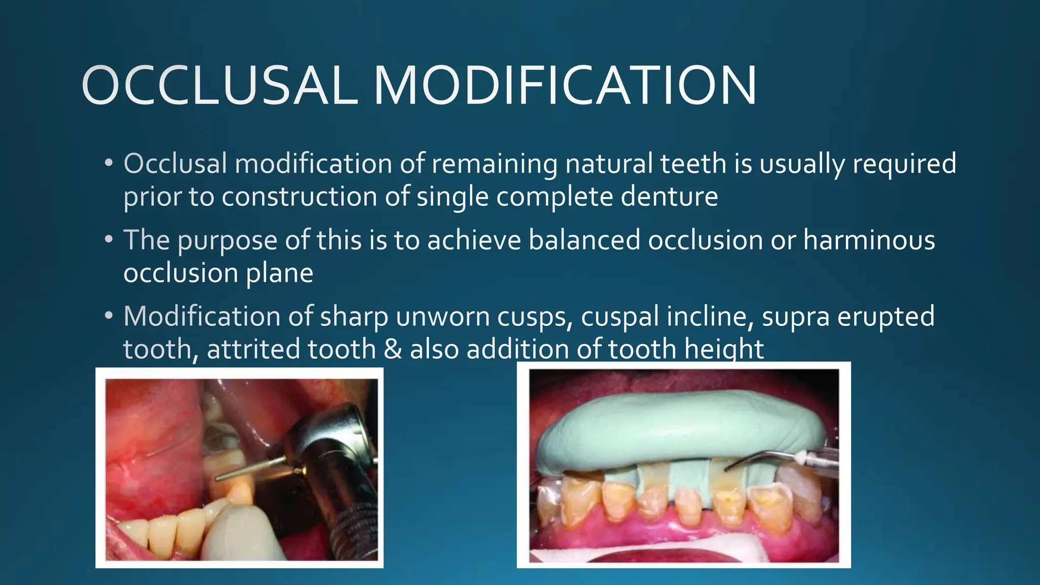 SINGLE MAXILLARY DENTURE AND ITS MANAGEMENT | PPTX
