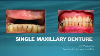 SINGLE MAXILLARY DENTURE AND ITS MANAGEMENT | PPT