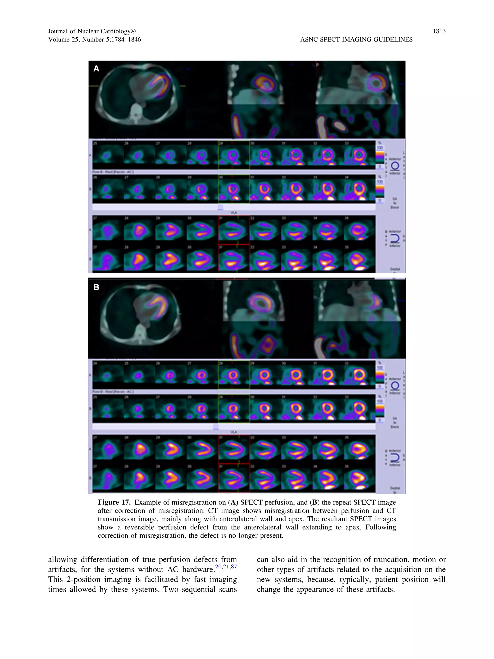 Single photon emission computed tomography spect | PDF
