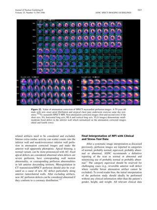 Single photon emission computed tomography spect | PDF