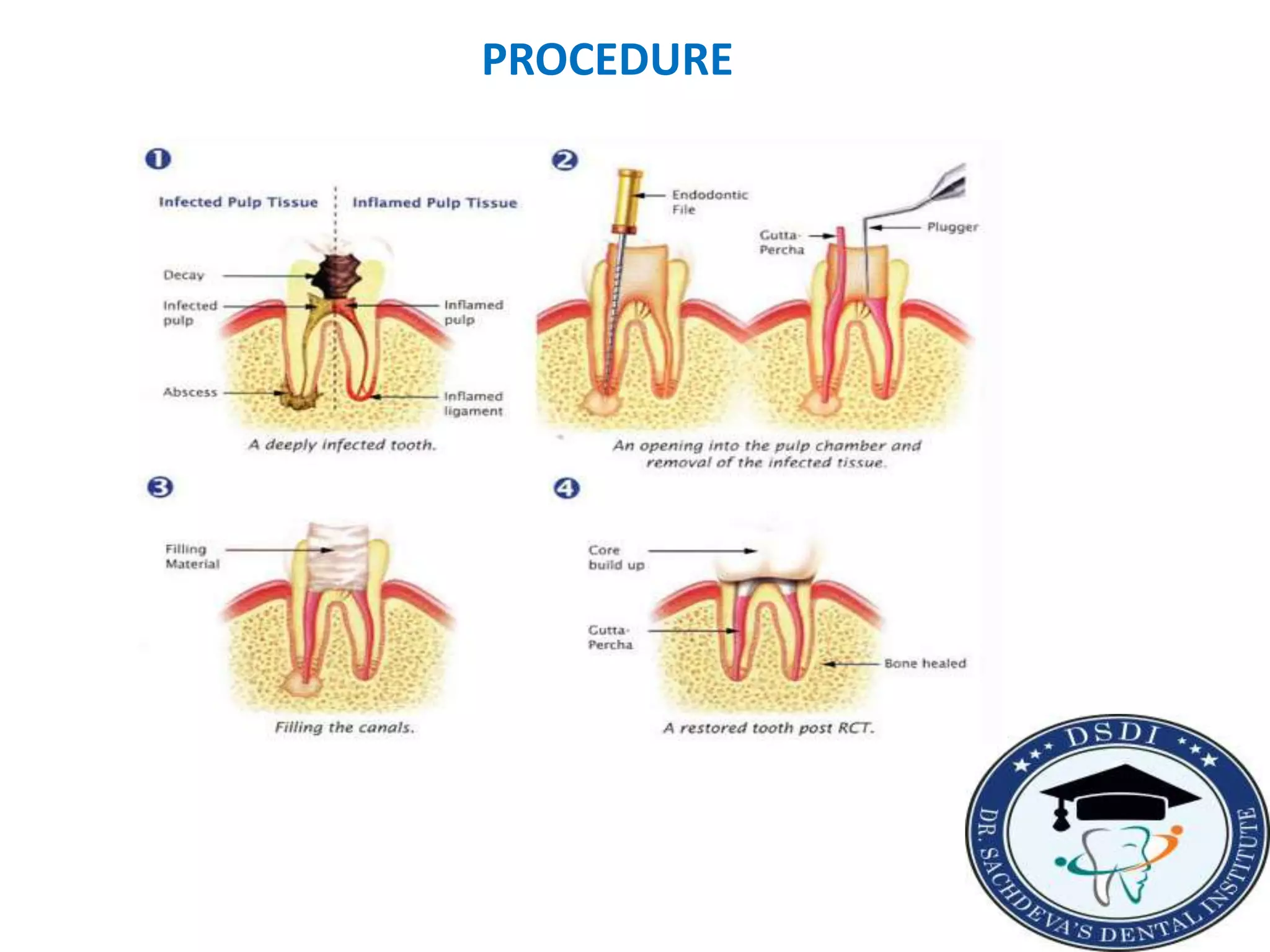 Single sitting root canal treatment. | PPTX