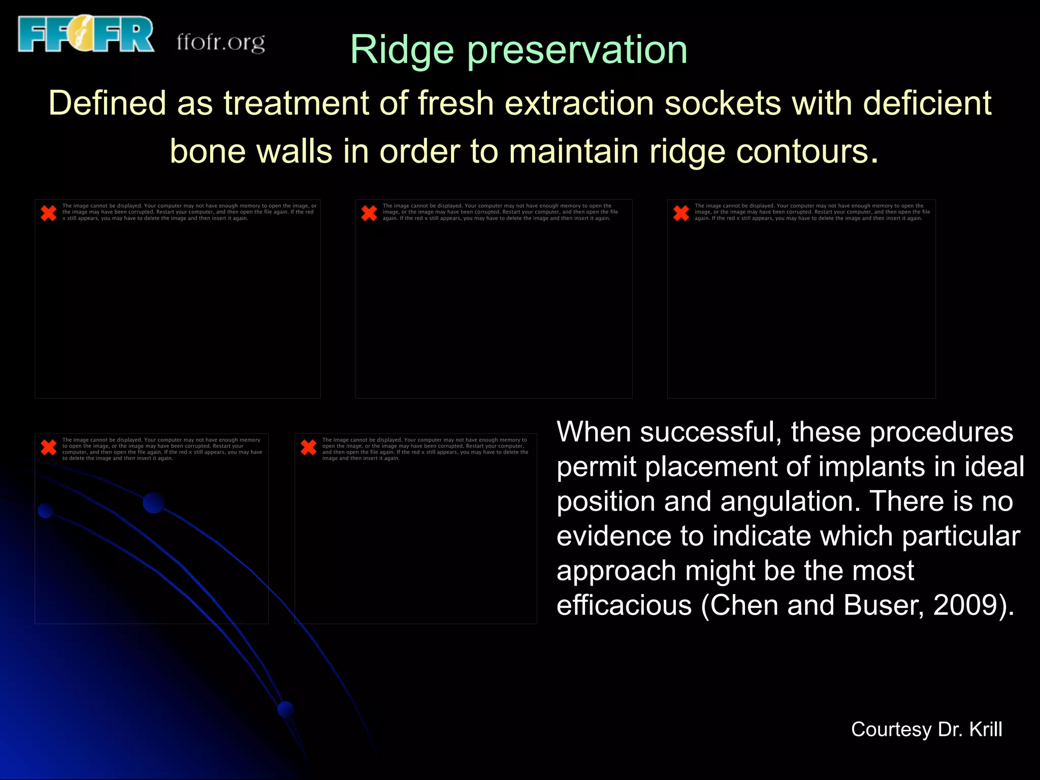 Single tooth defects in the posterior quadrants | PPT