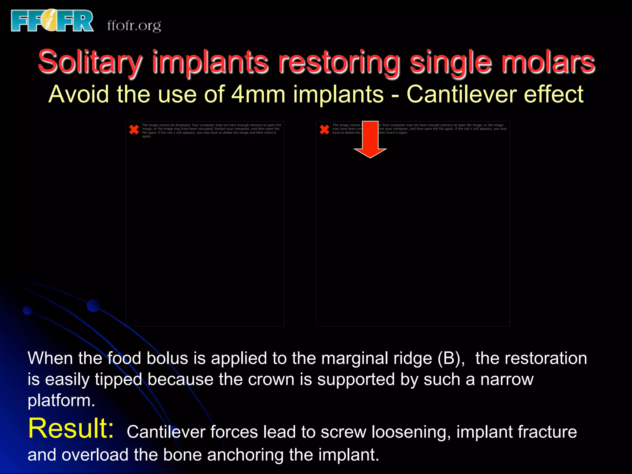 Single tooth defects in the posterior quadrants | PPT